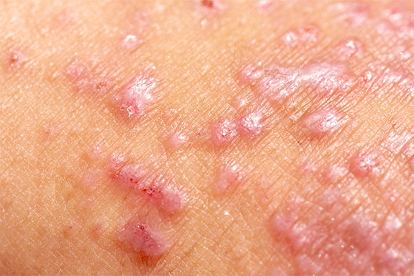 Tips To Help Identify Contact Dermatitis - NaturalHealth Tips To Help Identify Contact Dermatitis - NaturalHealth