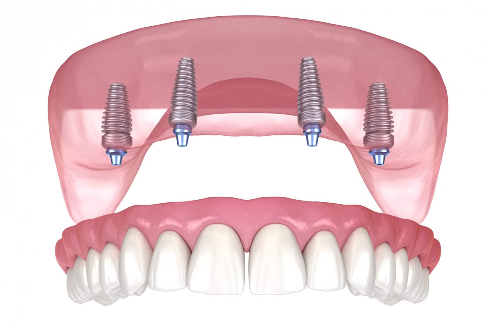 Benefits of All-on-4 Dental Implants for a Complete Smile Makeover